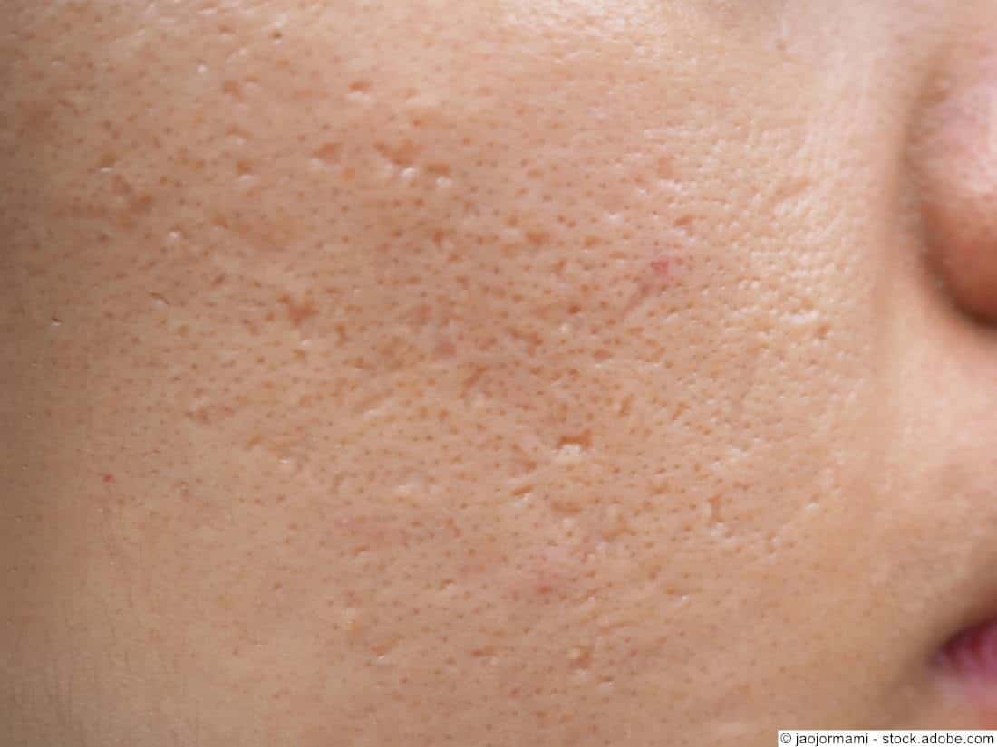 Aknenarben entfernen ᐅ Die besten Methoden auf einen Blick